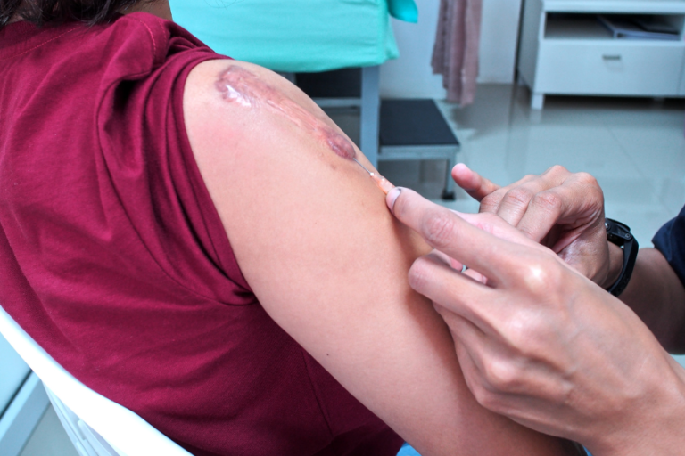 Keloid Scar Management: Cryotherapy Combined with Steroid Injections ...