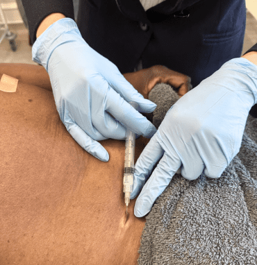 Keloid Removal London from £150 – Harley Street Clinic