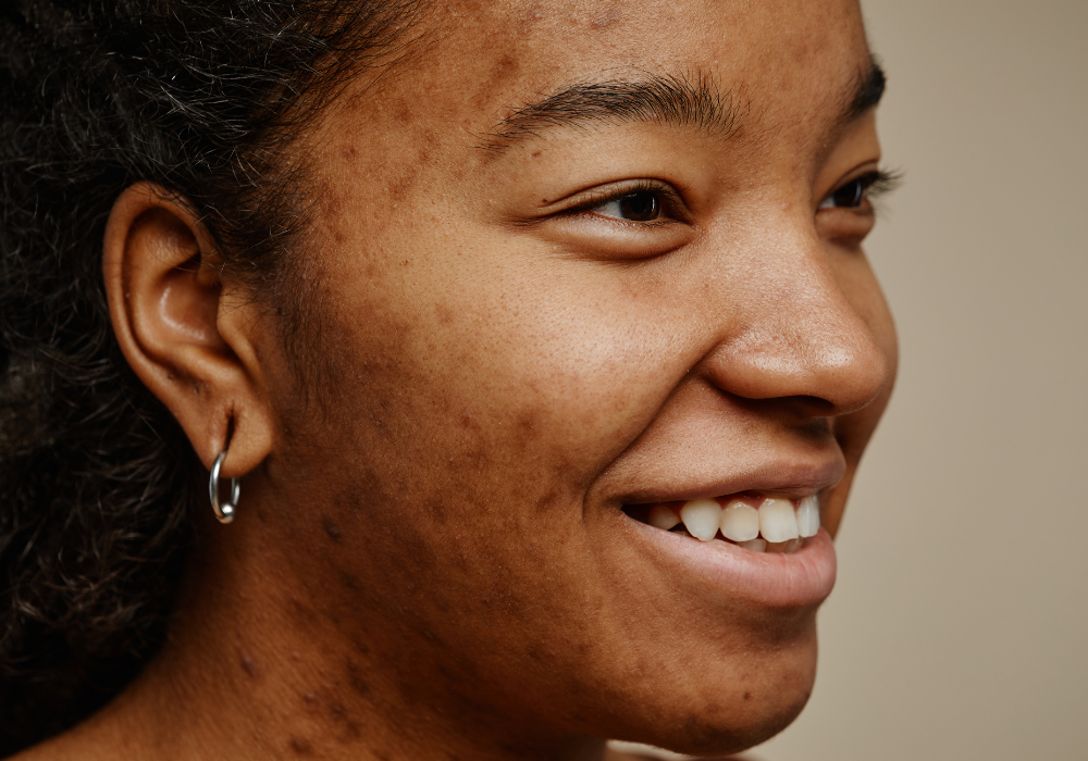 What Causes Keloids on Ears and How to Avoid Them - London Keloid Scar ...