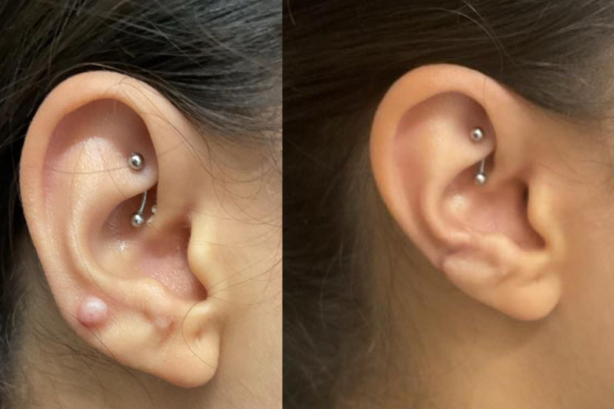 Ear Keloids: Why They Form, and How We Treat Them Differently - London ...